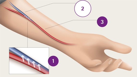 Hemodialysis: Unterstanding its Process